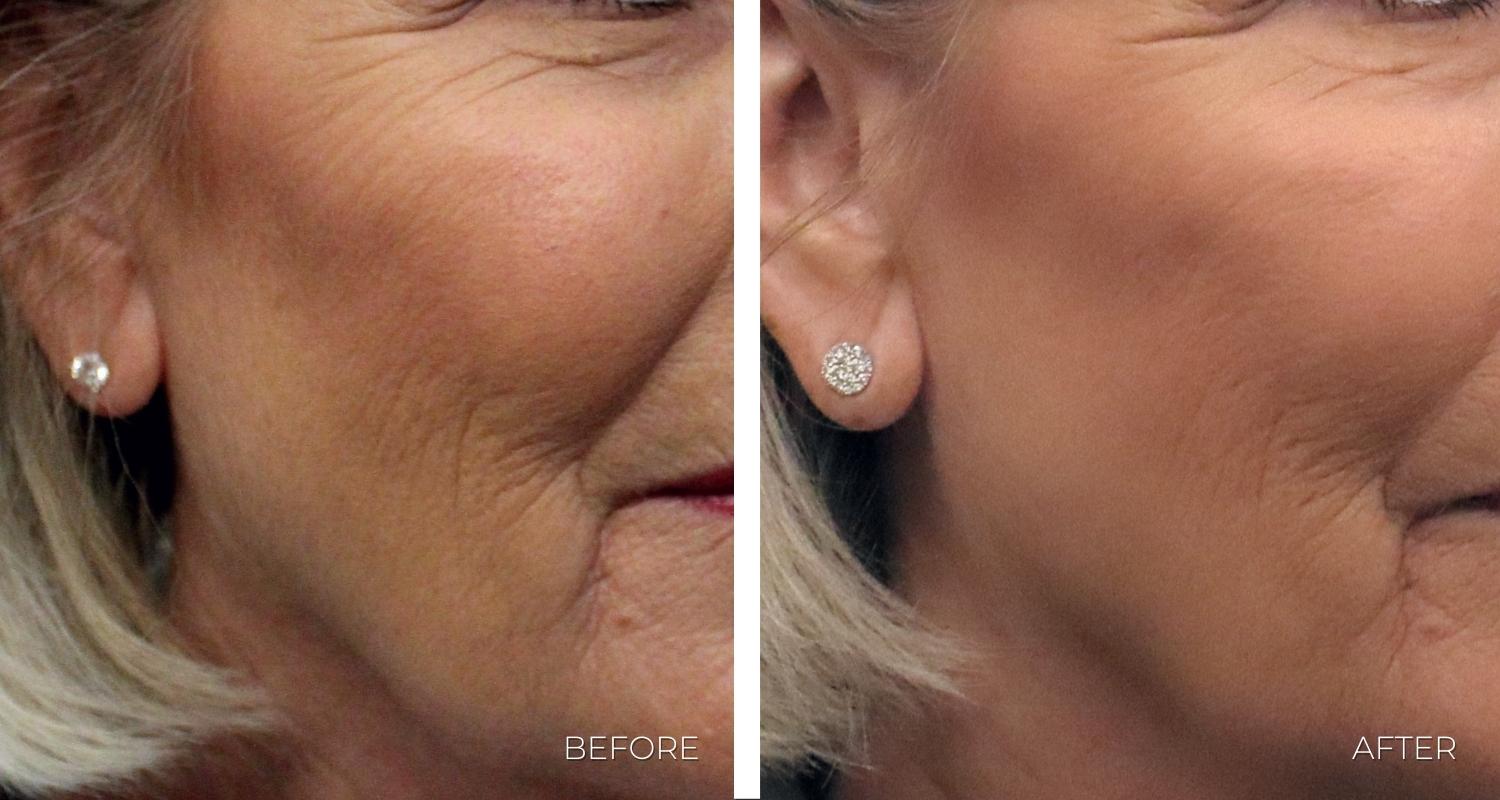 RF Microneedling Omaha - Omaha Cosmetic Center