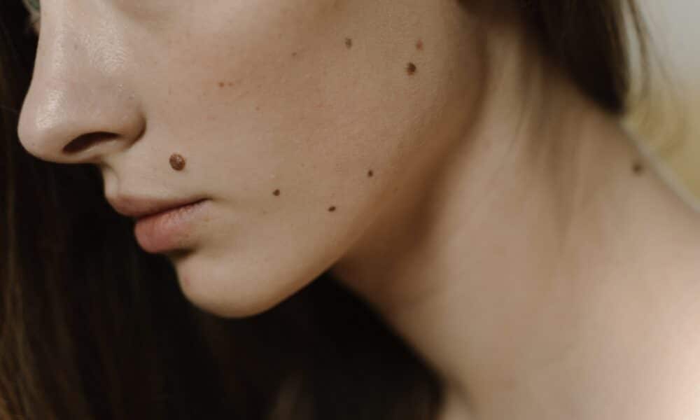 Mole Removal Recovery: Smooth Transition Back to Work